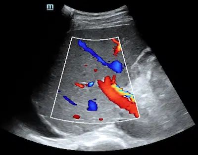 Understanding Liver Ultrasound and Its Benefits