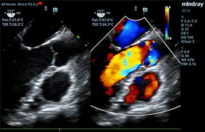 Getting to Know Ultrasound Transducers